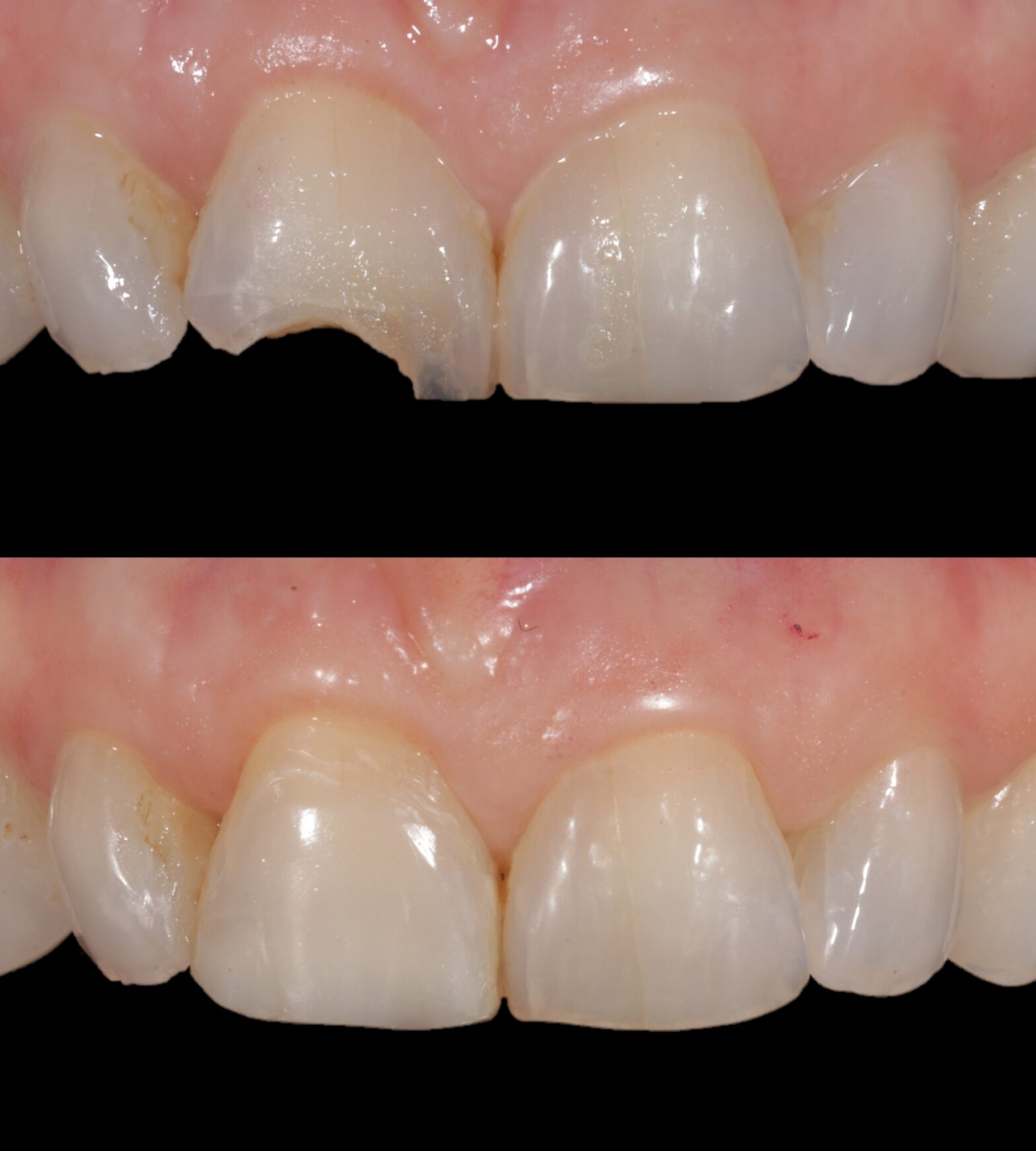 Cosmetic Dental Bonding Fort Lauderdale Pompano Beach FL